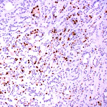 Sclerotic Fibroma | Basicmedical Key