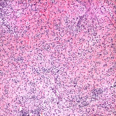 Sclerotic Fibroma | Basicmedical Key