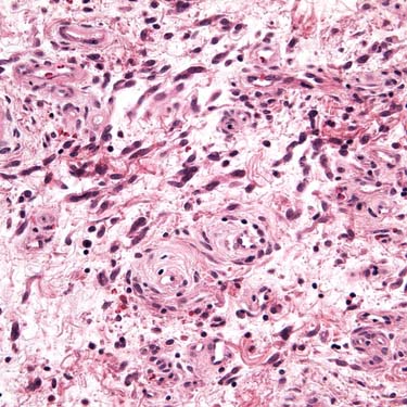 Angiomyofibroblastoma | Basicmedical Key