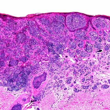Spitz (Spindle and Epithelioid Cell) Nevi | Basicmedical Key