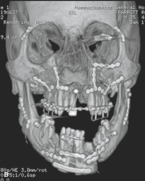 Maxillofacial Injuries | Basicmedical Key