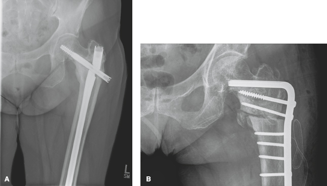 The Principles of Orthopedic Surgery for Trauma | Basicmedical Key