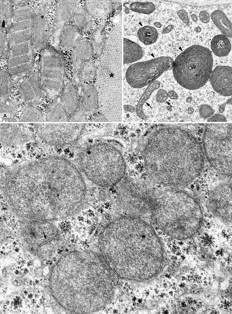 Cytoplasm: Mitochondria and Structural Abnormalities | Basicmedical Key