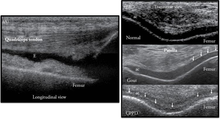 Acute Monoarticular Arthritis | Basicmedical Key