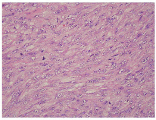 Fibroepithelial Lesions | Basicmedical Key