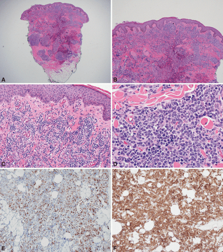 Cutaneous Involvement by Precursor B- and T-Cell Neoplasms ...