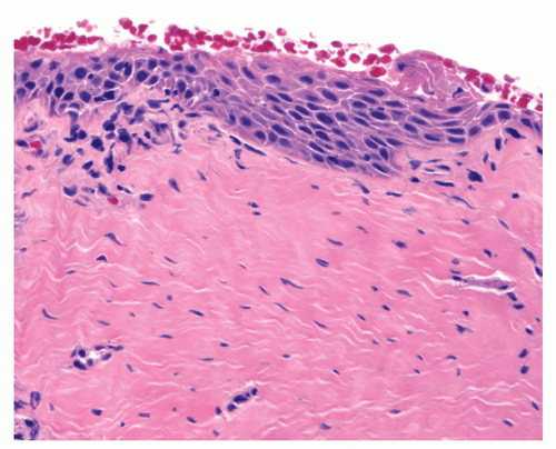 Precursor Lesions of Squamous Cell Carcinoma | Basicmedical Key