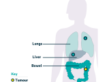 Rectal Cancer Diagram