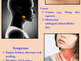Ranula Plunging Cyst And Surgery Bds Notes