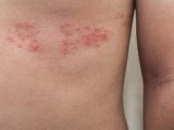 Shingles