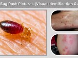 Bed Bug Rash Symptoms Pictures Causes And Treatment