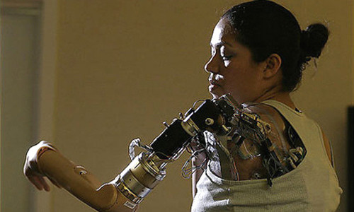 1st Woman With Bionic Arm