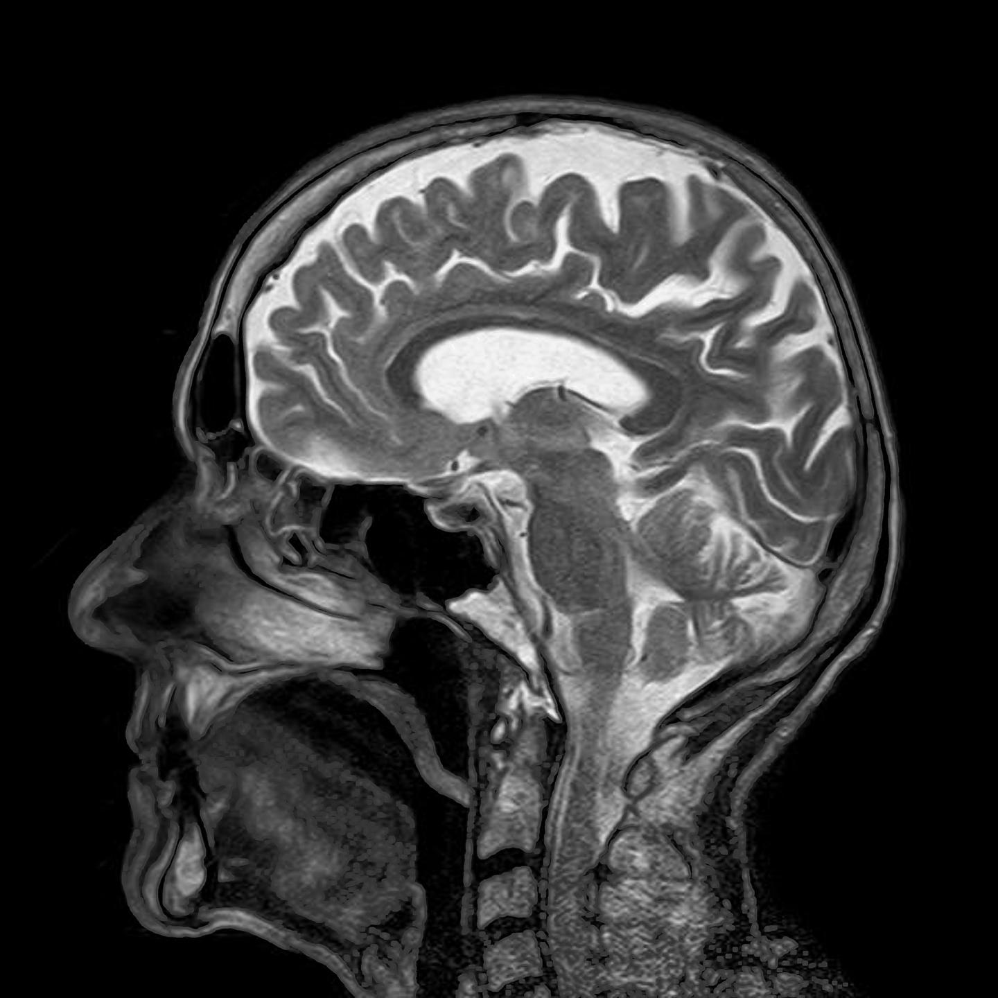 stroke-of-luck-scientists-discover-target-for-stroke-therapy-in