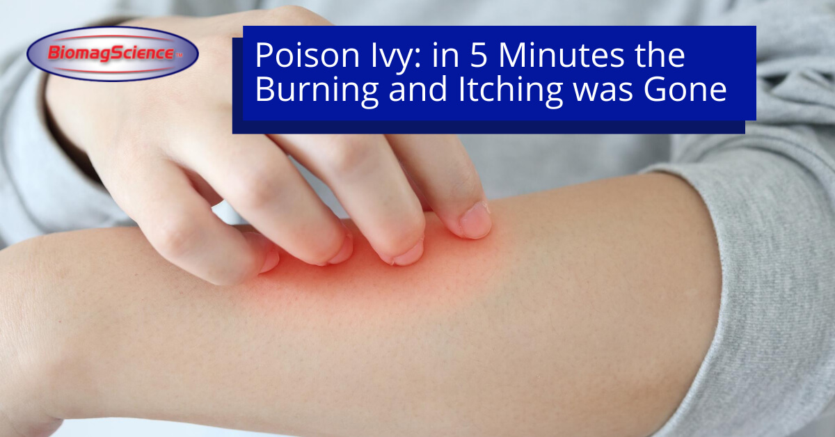 Poison Ivy: In 5 Minutes The Burning And Itching Was Gone - BiomagScience