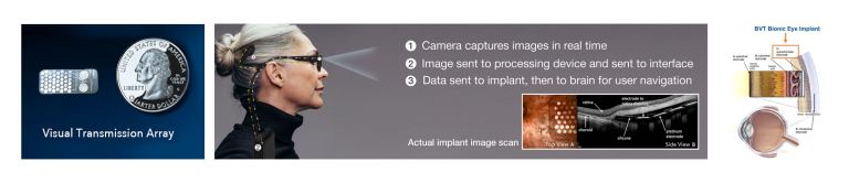 Technology - Bionic Vision Technologies