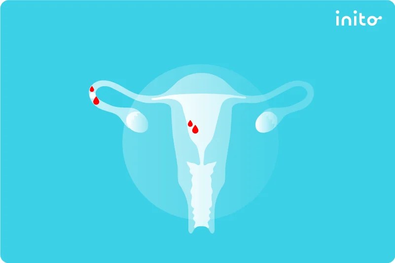Ovulation Bleeding Vs Implantation Bleeding How Long Does It Last ovulation-bleeding-vs-implantation-bleeding-how-long-does-it-last
