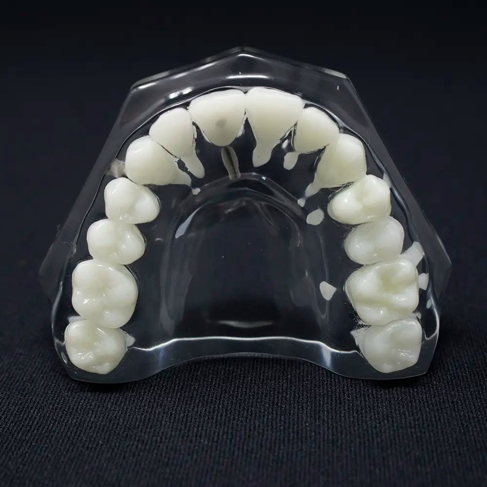 Crown and Bridge Implant Supported - BoneModels™