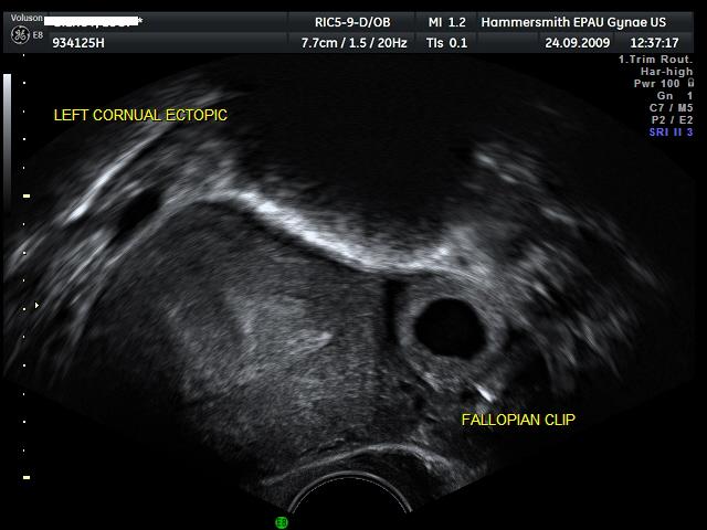Cornual Pregnancy Ultrasound