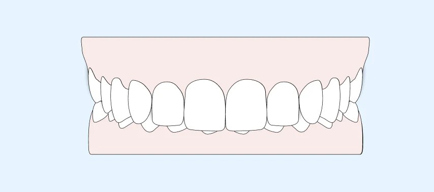 Deep Bite Correction Caspersmile Aligners