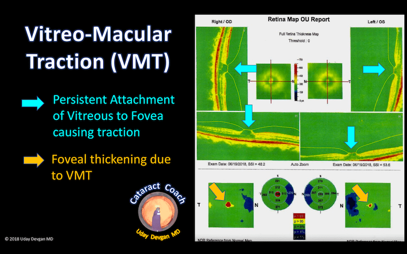 If you see VMT on OCT, do not do cataract surgery! – Cataract Coach™
