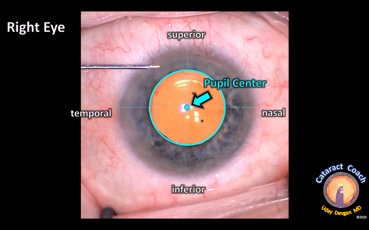 Angle Alpha and Angle Kappa with IOLs – Cataract Coach