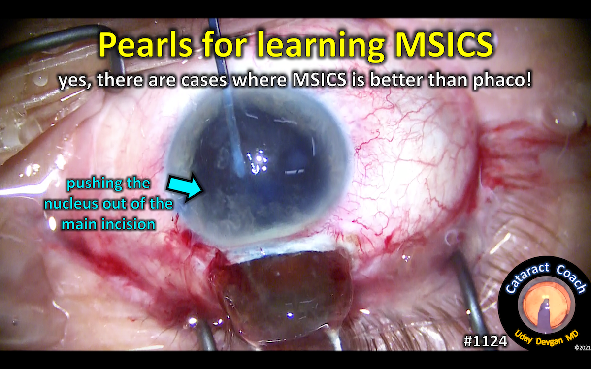 brunescent cataract – Cataract Coach