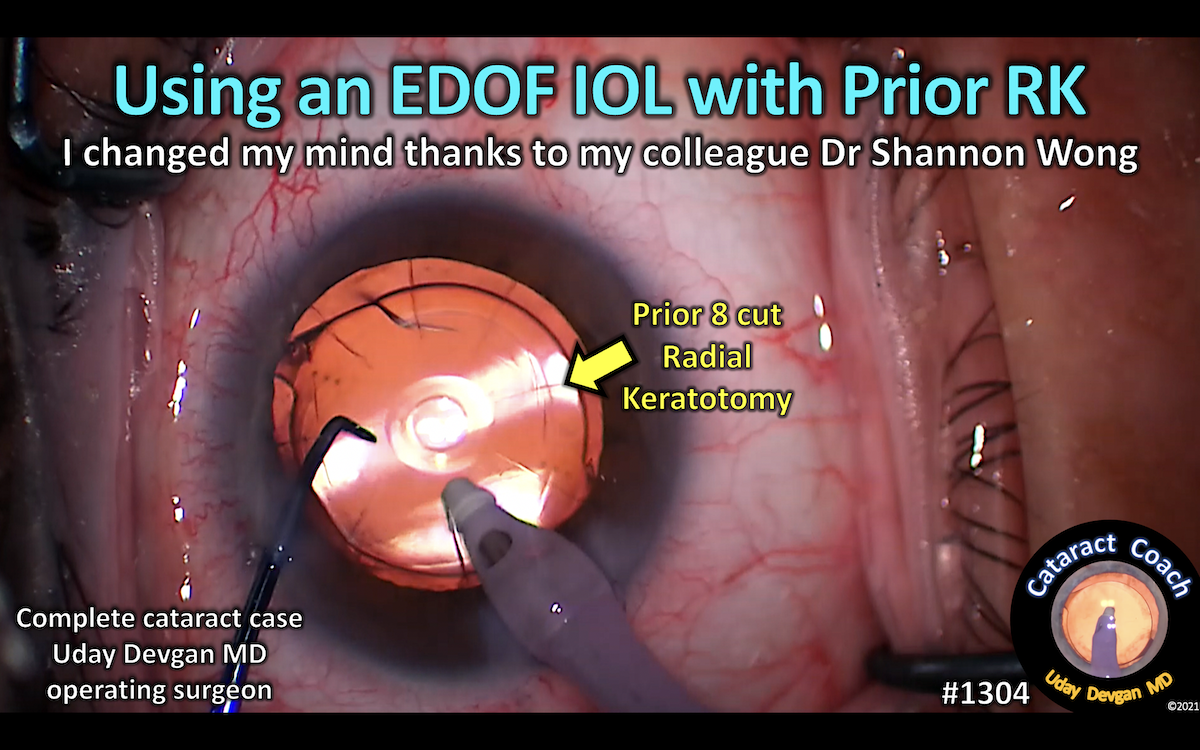 1304: EDOF IOL with Prior RK – Cataract Coach™