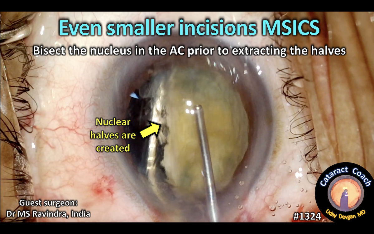 1324: even smaller incision MSICS – Cataract Coach