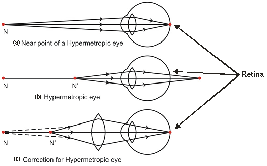 Defects of Vision and Their Corrections | Human Eye and Colourful World ...