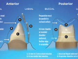 Zirconia Crowns Preparation