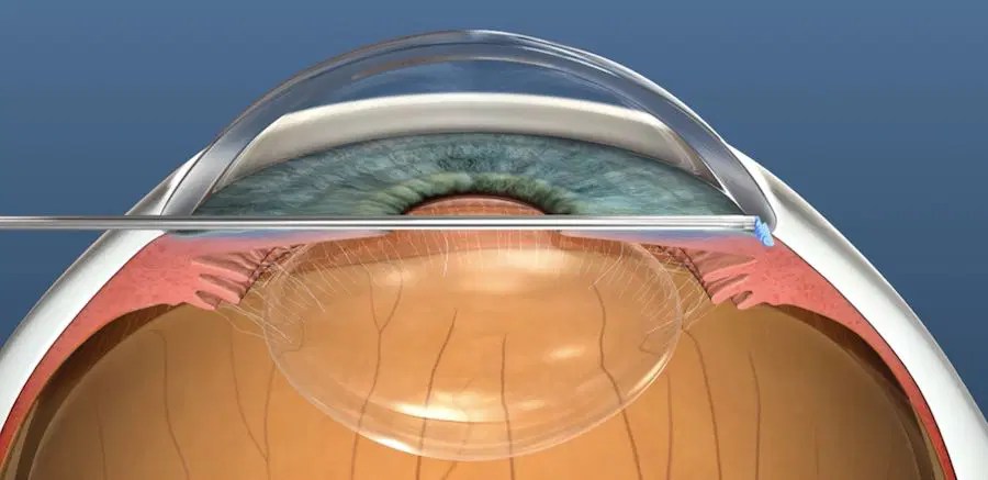 Minimally Invasive Glaucoma Surgery Migs Dr Nathan Kerr