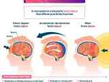 How Long Does Post Concussion Syndrome Last