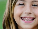 Can You Get Braces If You Have Missing Teeth Wiewiora Dunn