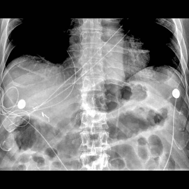 Toxic Megacolon | Clinical Gate