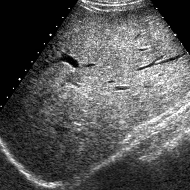 Hepatomegaly | Clinical Gate