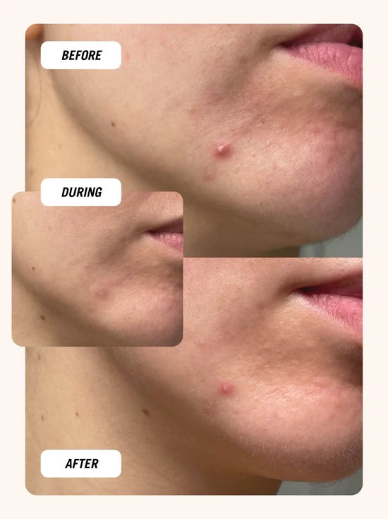 Cloud Pimple Patch From Vegan Hydrocolloid For Acne Prone Skin