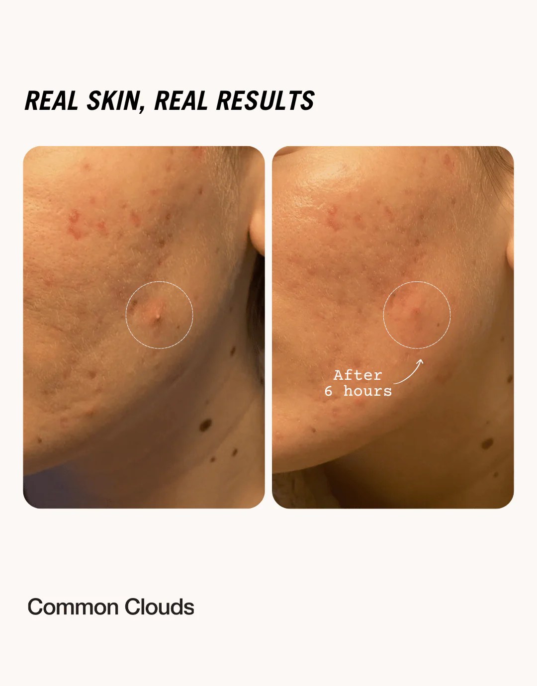 Cloud Pimple Patch From Vegan Hydrocolloid For Acne Prone Skin