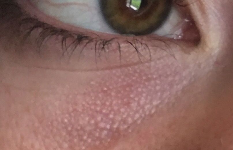 Under Eye Bumps Not Milia Beauty Insider Community