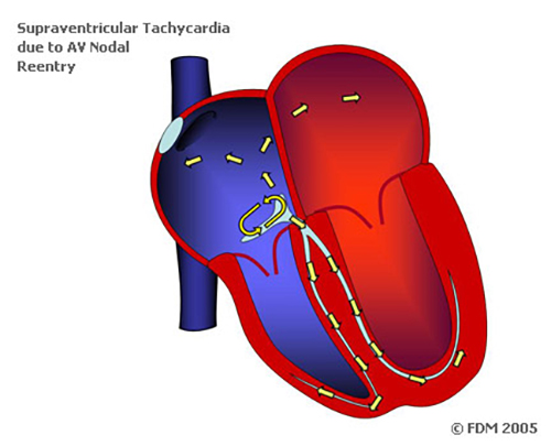 Atrioventricular Nodal Reentrant Tachycardia – Core EM