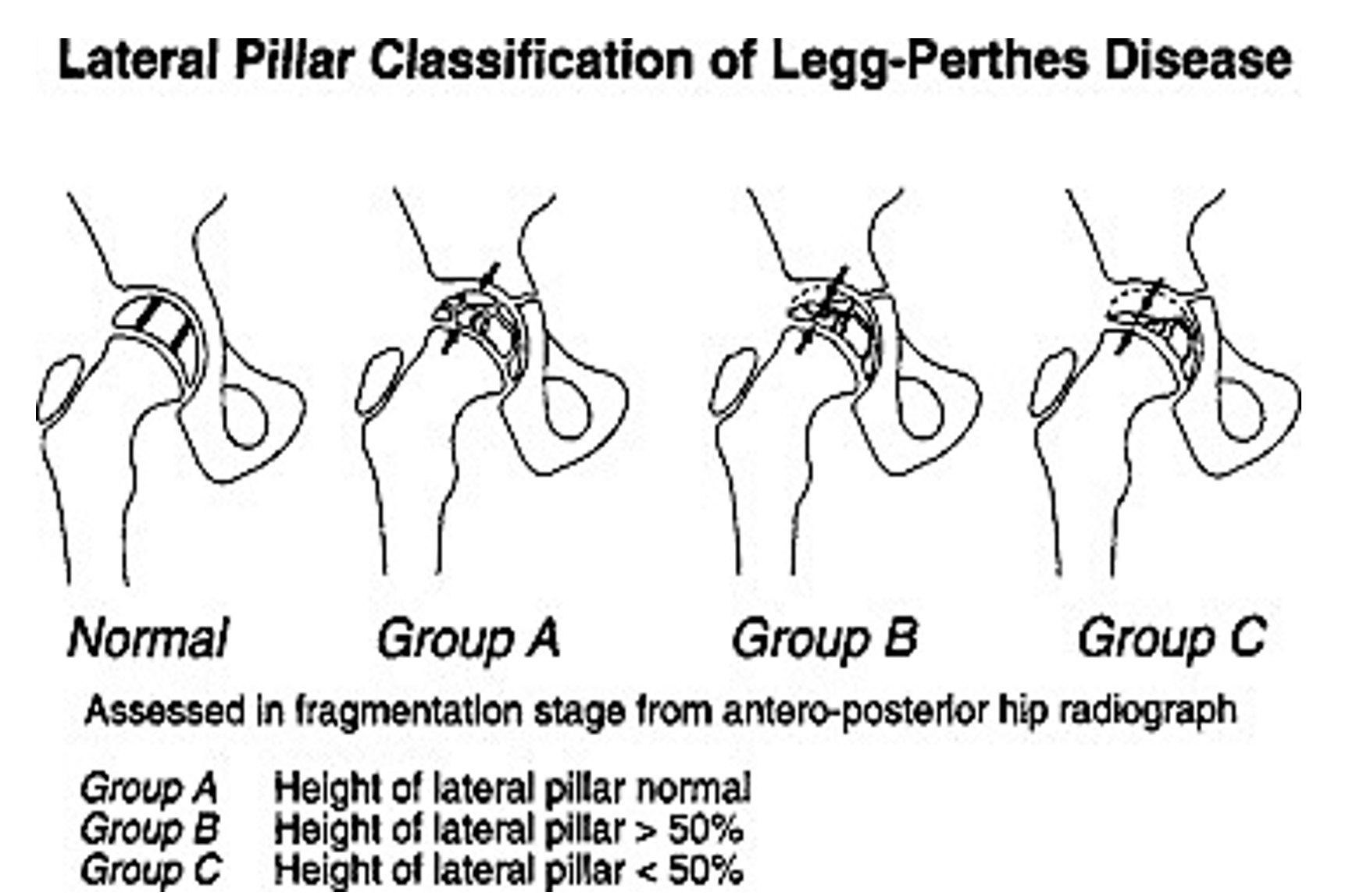 Legg Calve Perthes Disease Core EM Legg Calve Perthes Disease Core EM
