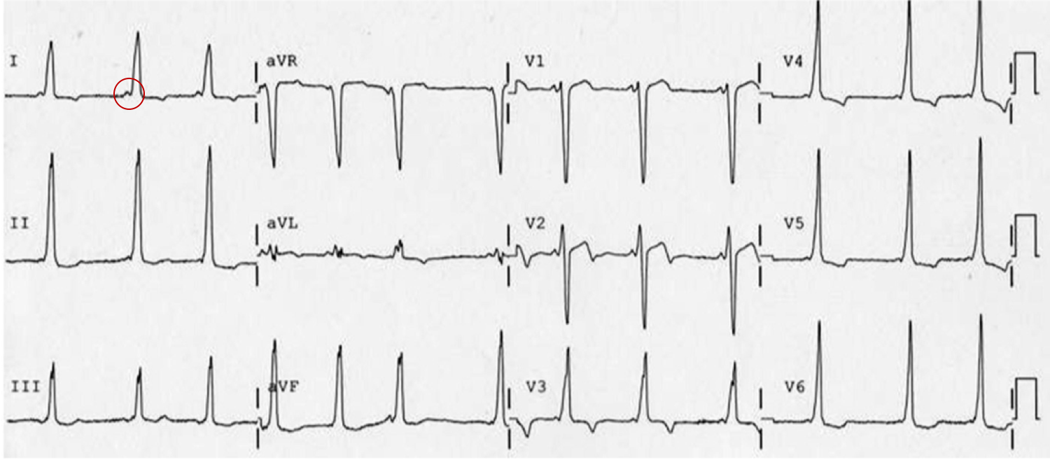 ECG / EKG; Types, Indications/Uses, Procedures, Results - illnesshacker