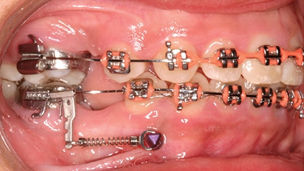 Clinical Uses for Temporary Anchorage Devices - Decisions in Dentistry