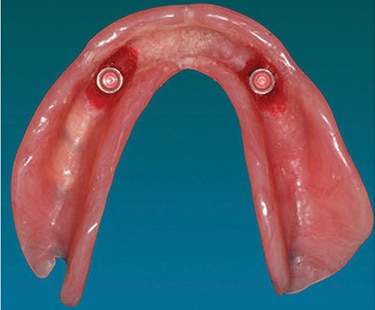 The Case for Implant-Retained, Tissue-Supported Overdentures ...