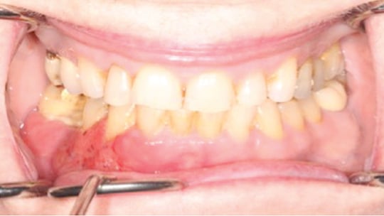 Gingival Cancer Overview for General Practitioners - Decisions in Dentistry