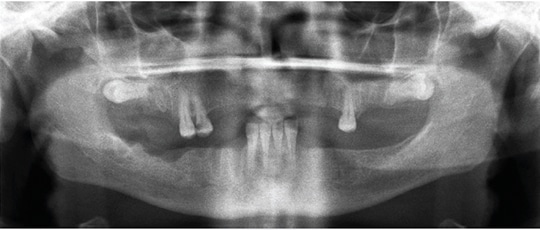 Managing Subcutaneous Emphysema Following Dental Procedures - Decisions ...