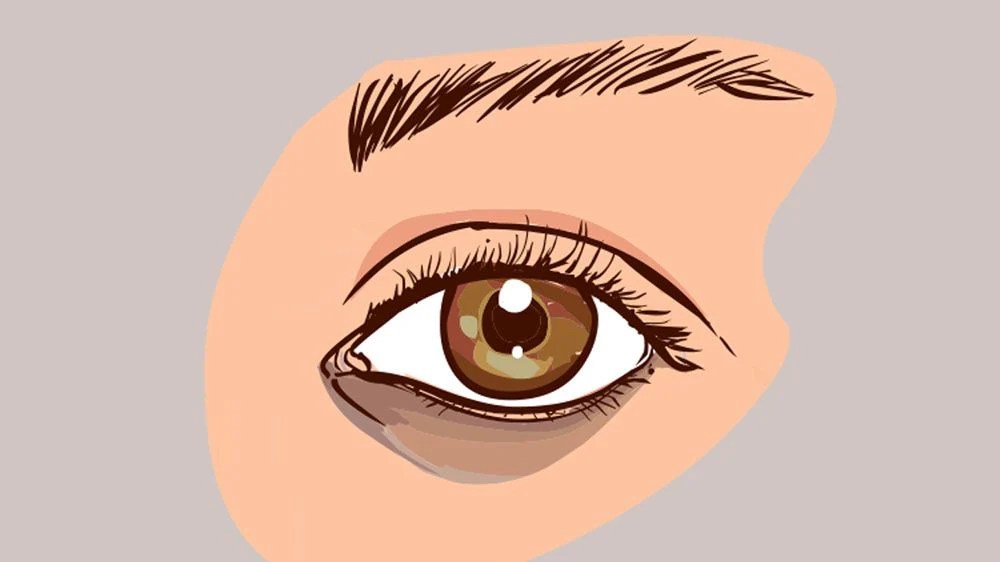 Understanding Dark Circles Causes And Remedies