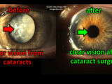 Why Do I See Halos Around Lights After Cataract Surgery Shelly Lighting