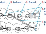 Braces Diagram Devon Ortho