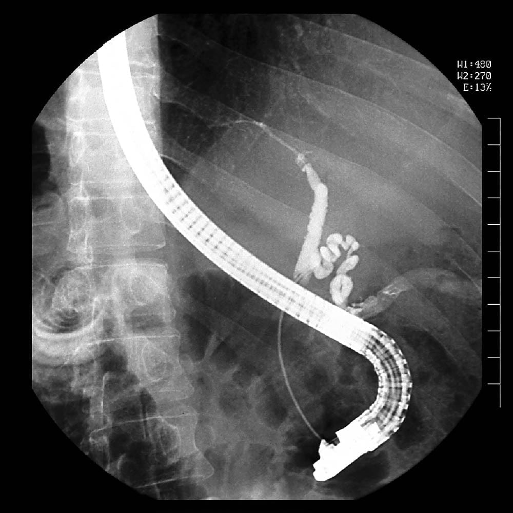 Surgeon Perforates Organs During ERCP Procedure