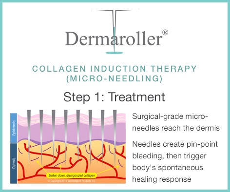 Microneedling | Dolce Spa Surrey BC